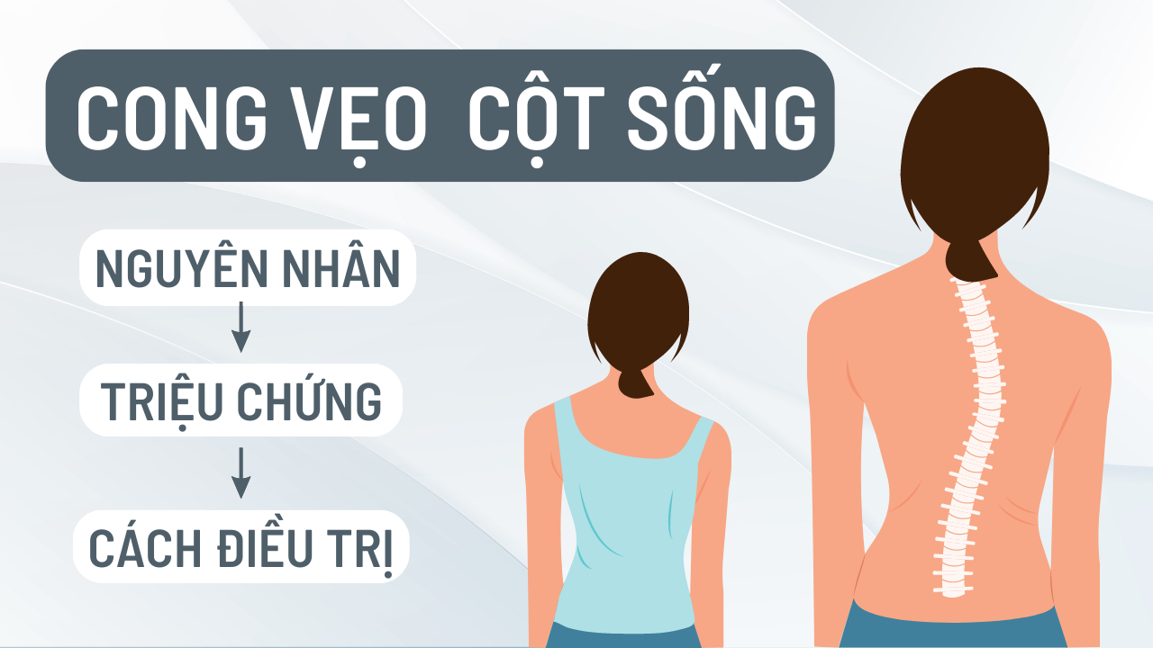 Cong Vẹo Cột Sống: Nguyên Nhân, Triệu Chứng và Cách Chữa Trị - Nguyên Yoga